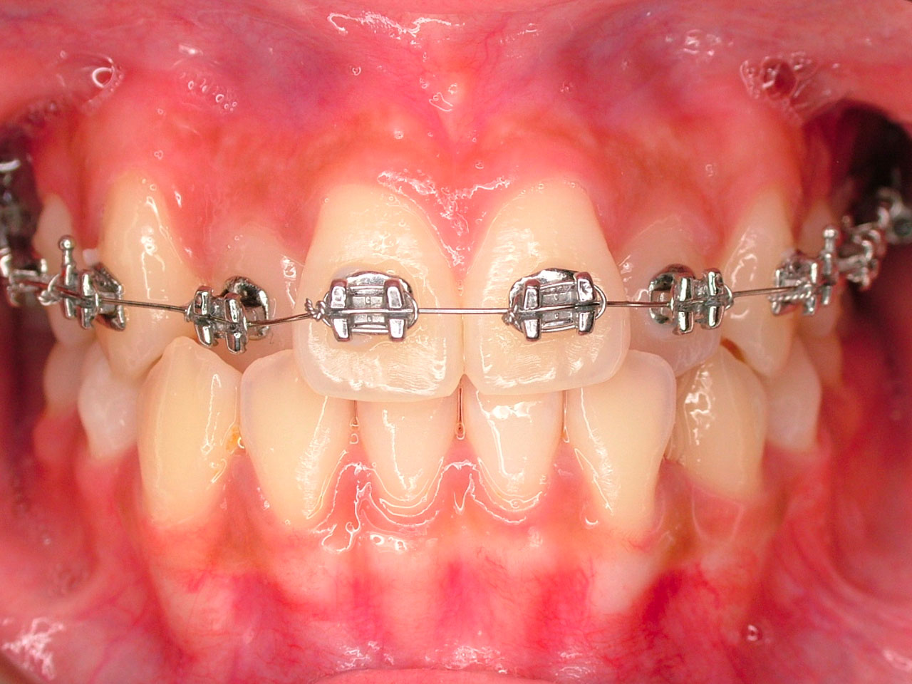 Ortodonzia fissa tradizionale - terapie - Dr. Colosimo - Dentista Roma